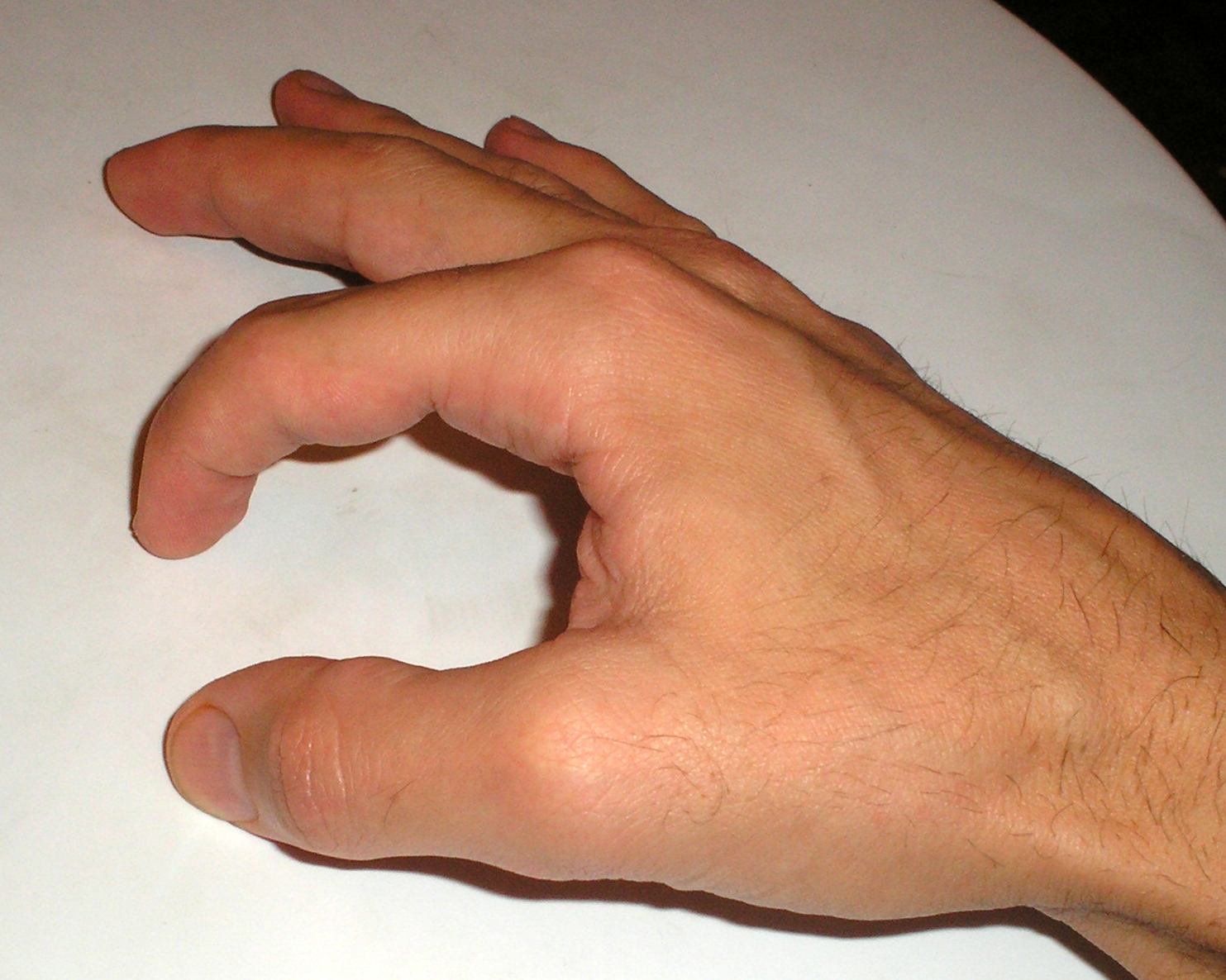 Artrose in het PIP-gewricht | PIP-gewrichten | Symptomen