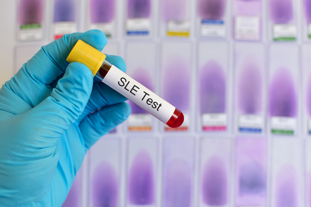 Lupus erythematodes | Diagnose, Betekenis, Symptomen, Erfelijk