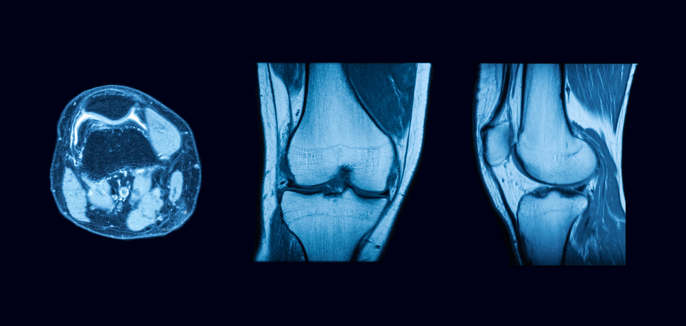 MRI-scan bij Artrose (Reuma) in Schouder, Nek, Enkel, Rug