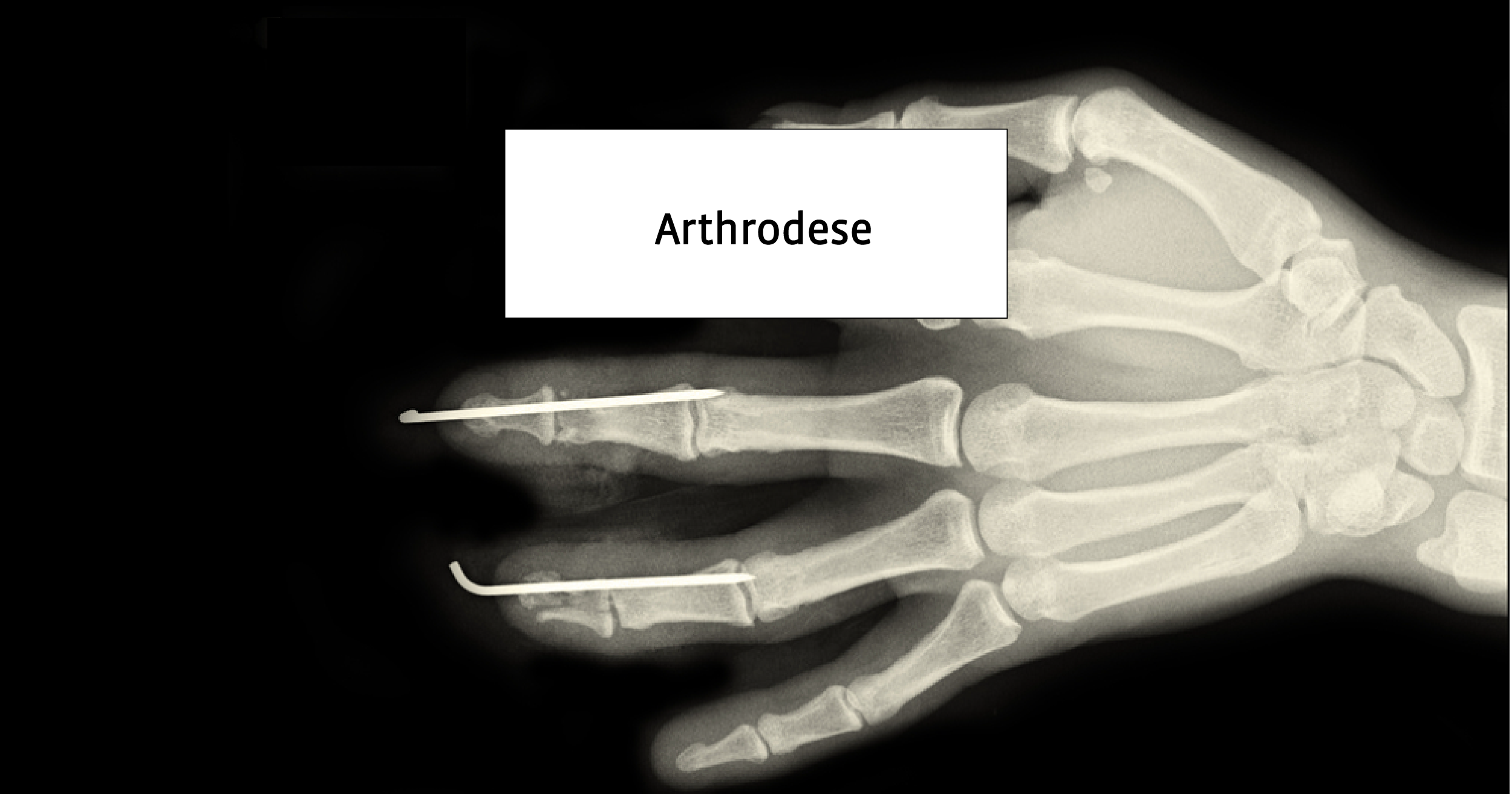 Arthrodese in Pols, Voet, Schouder of Enkel | Wat je moet weten!