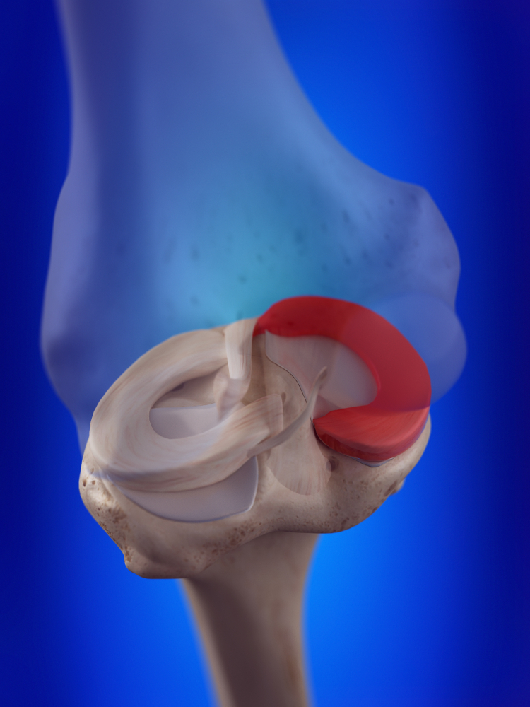 Artrose na meniscus operatie | Meniscus beschermt kraakbeen