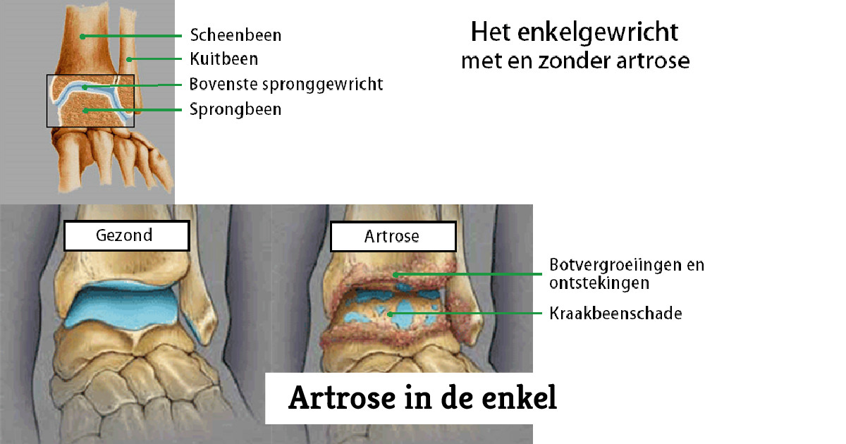 Artrose in de enkel | Enkelgewricht | Met oefeningen